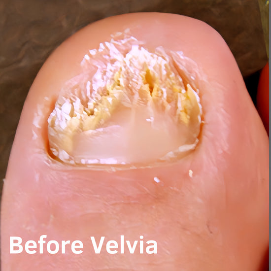 Velvia™ Antifungal Pen (Copy)